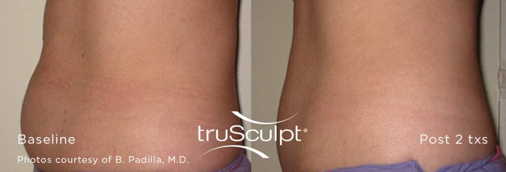 Body Contouring With Trusculpt Id Premier Ob Gyn And Med Spa Aesthetics